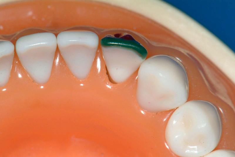 Mandibular Right Lateral Incisor 4 2 FDI 26 Universal Labial And Mandibular Right Lateral Incisor 4 2 FDI 26 Universal Labial And